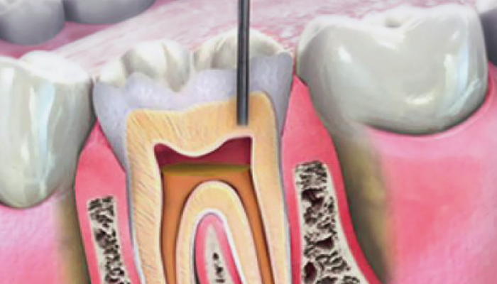 Devitalizzazione: cos'è e come viene effettuata - Centri Dentistici Primo