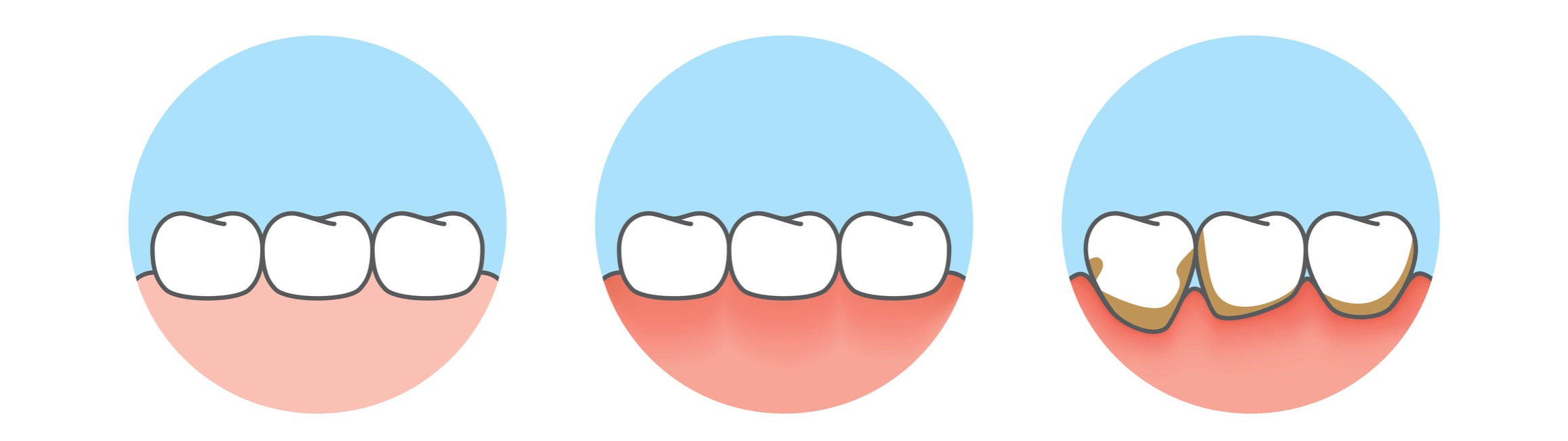 Parodontite: cause, sintomi e cura | - Centri Dentistici Primo