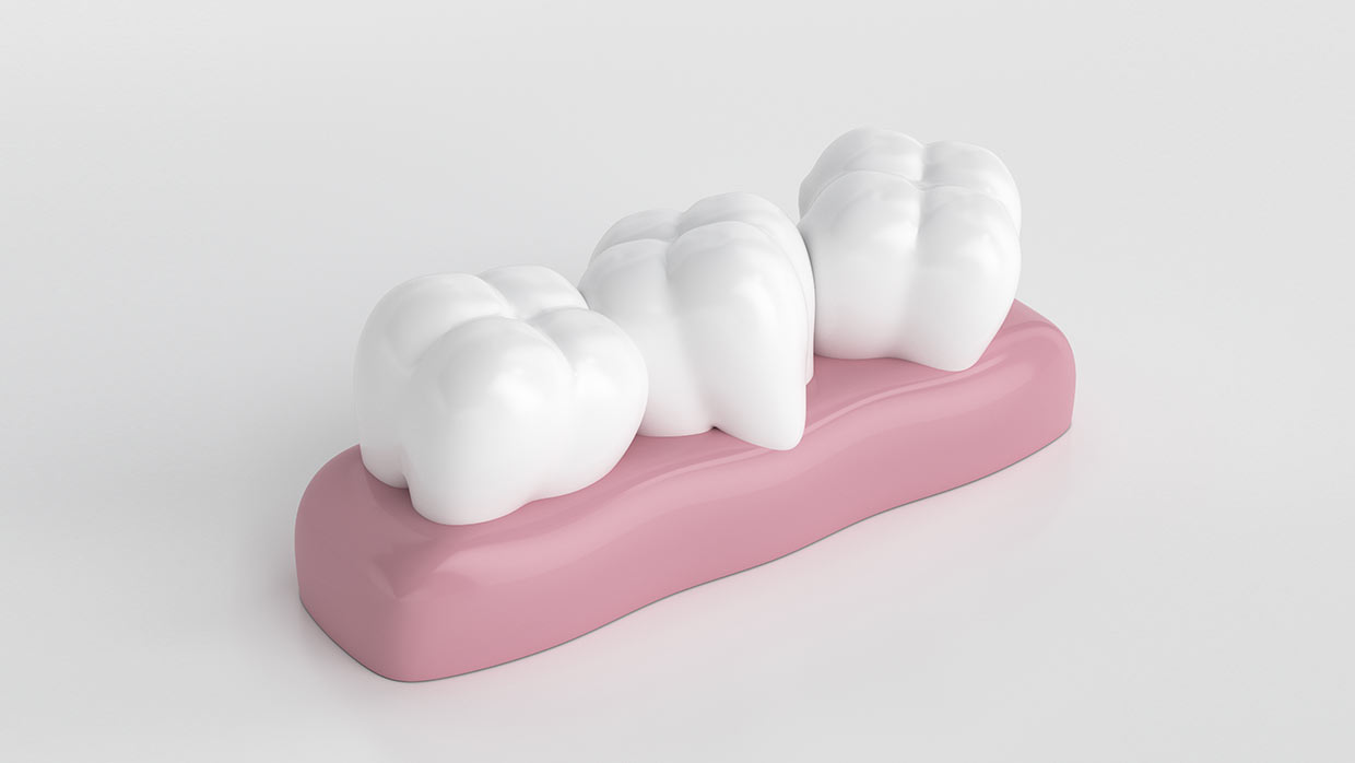 Malocclusione dentale: cos'è, le 3 classi, e come intervenire