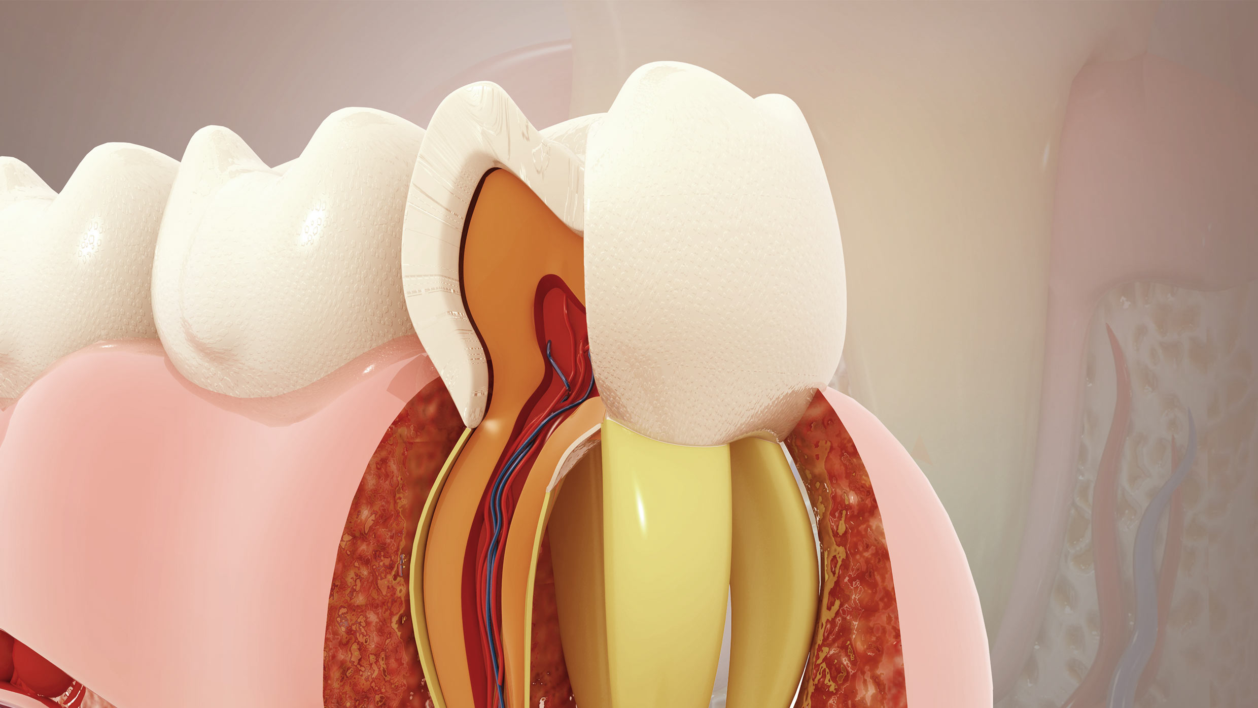 Quando e come viene fatta la ricostruzione del dente - Centri ...