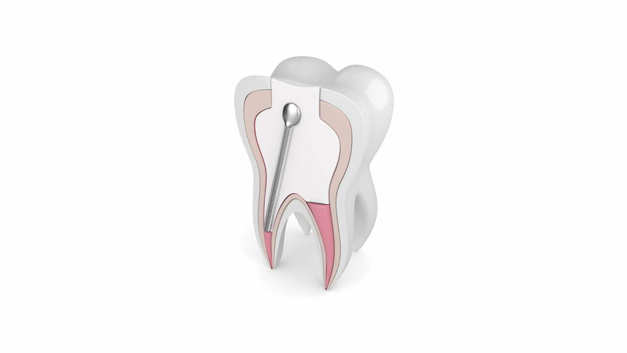 Cos'è il perno moncone e quando viene fatto - Centri Dentistici Primo