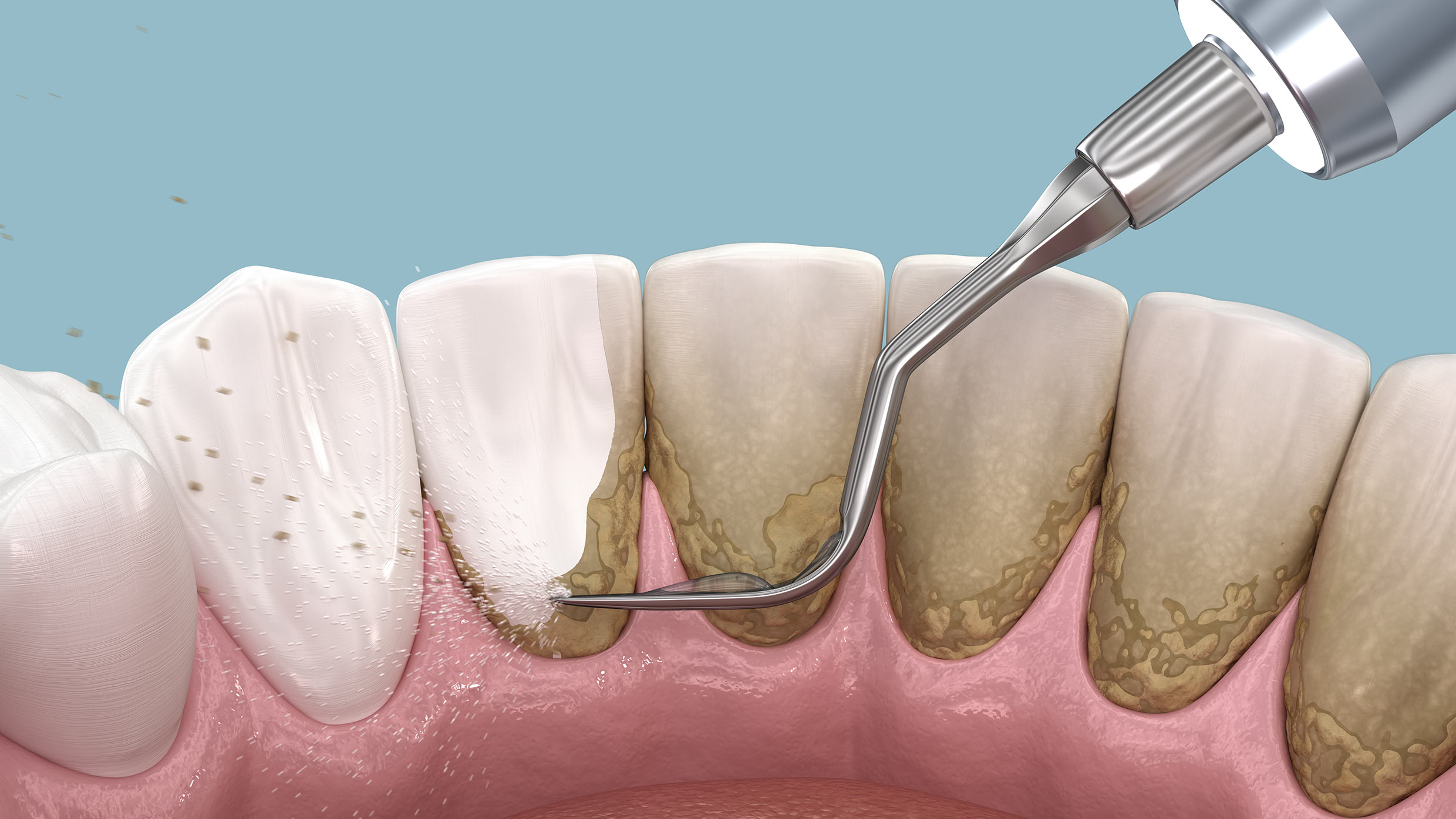 Malattie parodontali: sintomi, cause e trattamenti - Centri Dentistici ...