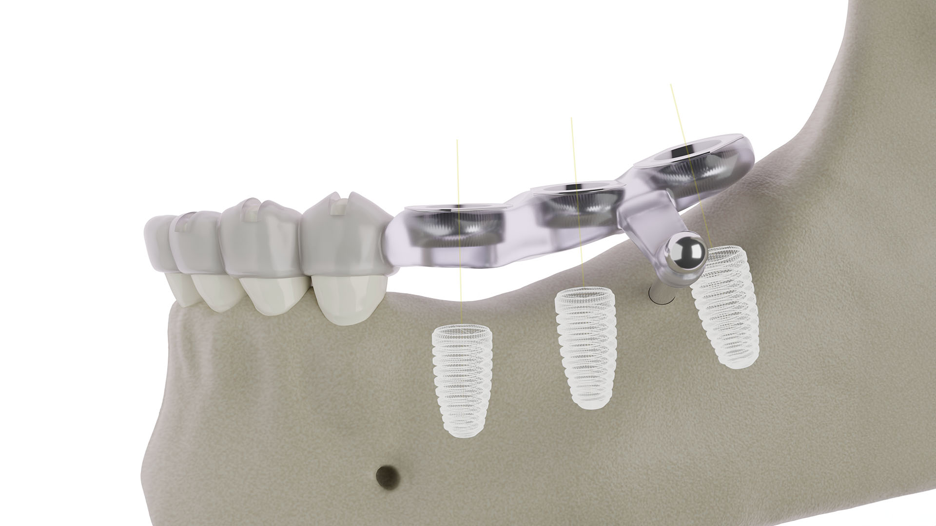 Vantaggi e utilizzo della chirurgia computer guidata in implantologia ...