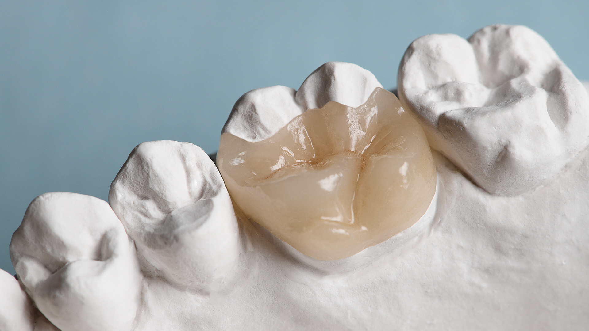 Otturazioni in composito - Centri Dentistici Primo