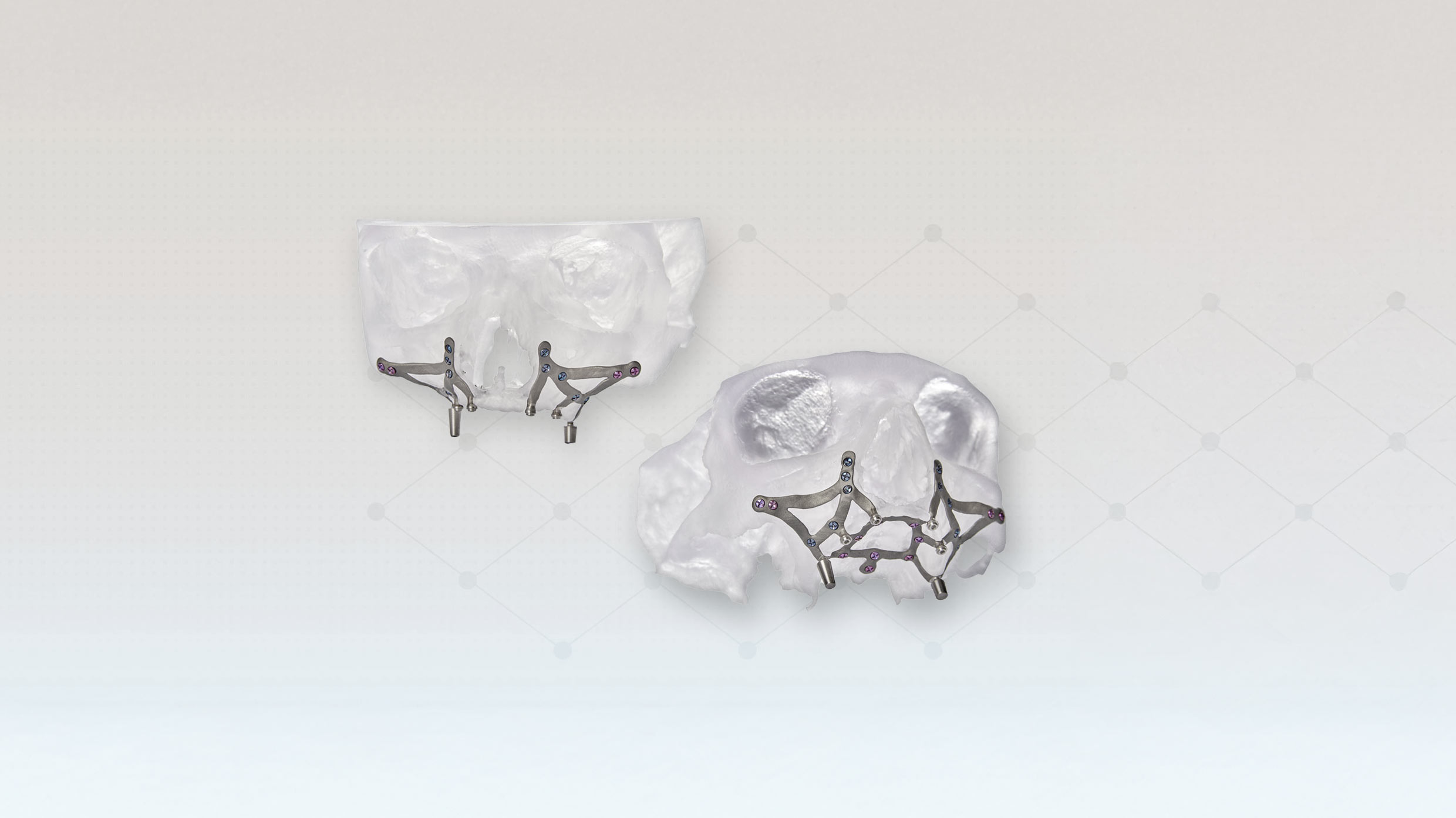 Impianti dentali con poco osso - Centri Dentistici Primo